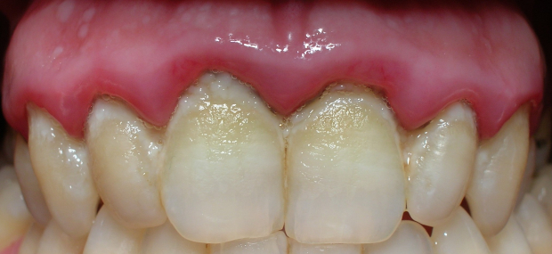 Sarro dental: cómo prevenirlo y eliminarlo en simple pasos, aquí ...